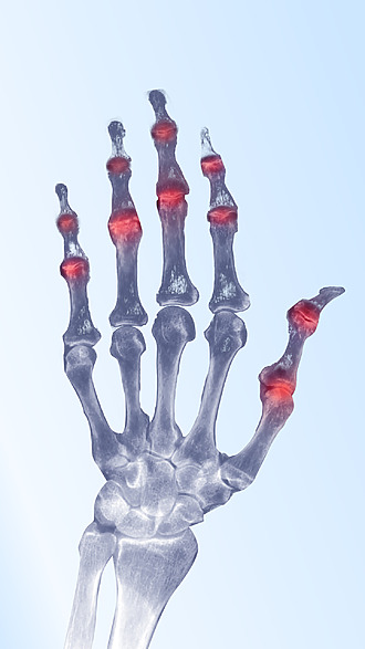 Artróza - popis, léčba a doporučení lékařů