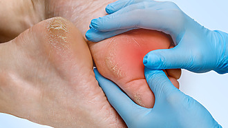 Diabetická noha - popis, léčba a doporučení lékařů