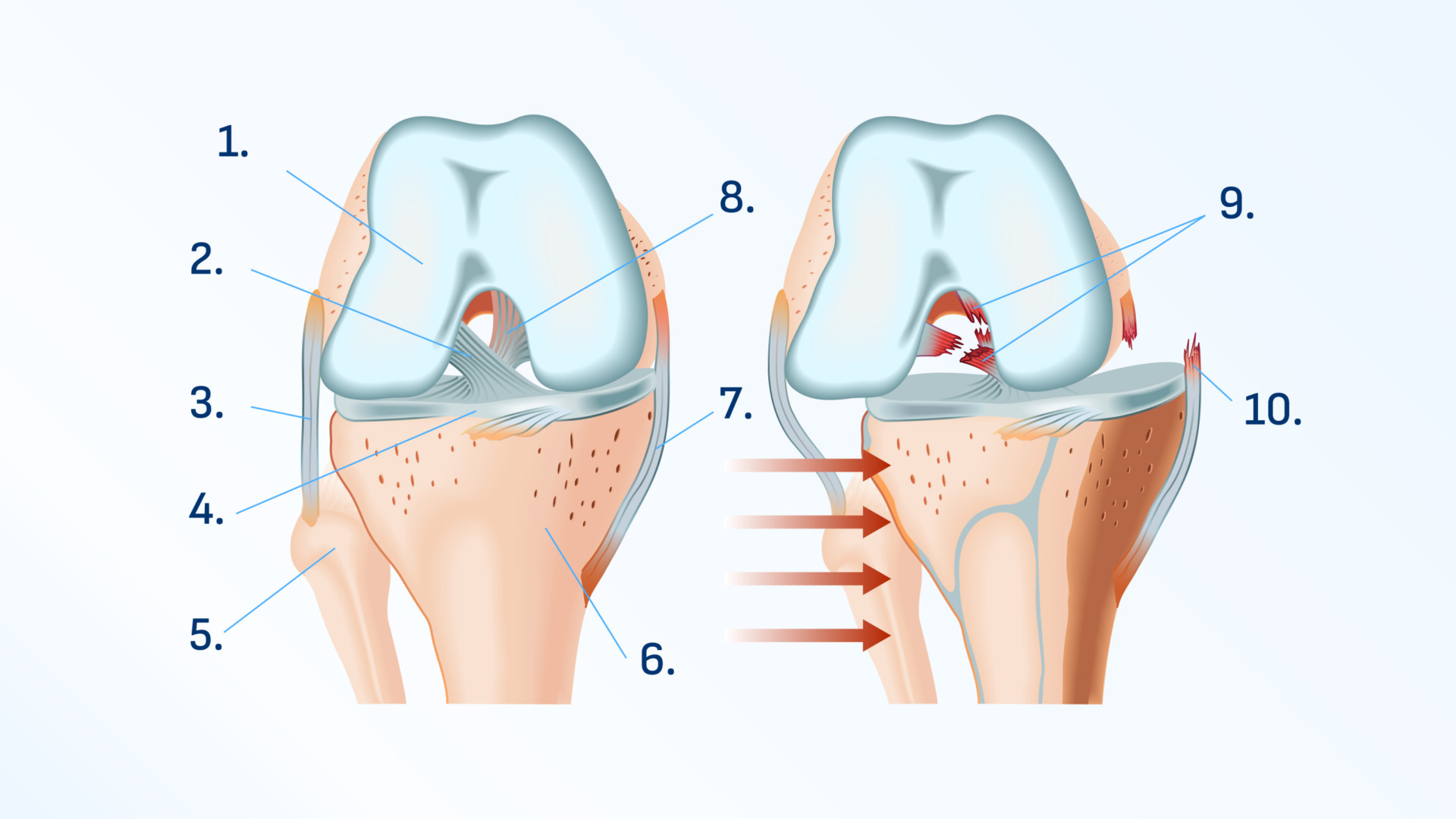 Bolest kolene - popis, léčba a doporučení lékařů
