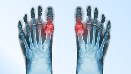 Dna - popis, léčba a doporučení lékařů