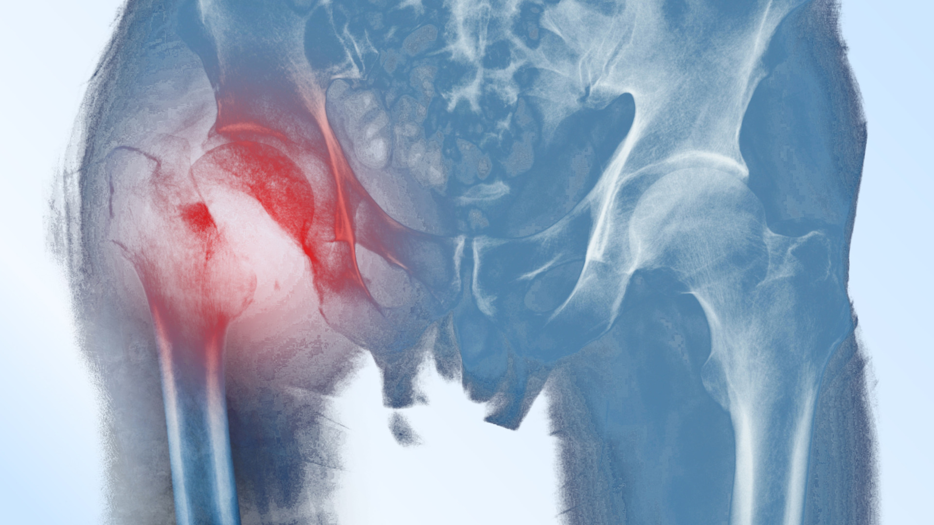 Bolest kyčle - popis, léčba a doporučení lékařů